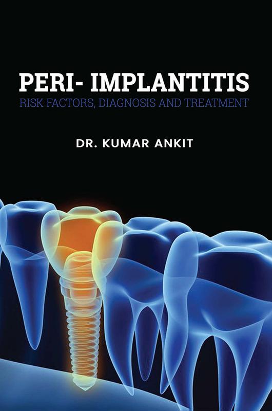 Bookscape | Buy Peri-Implantitis: Risk Factors Diagnosis And Treatment